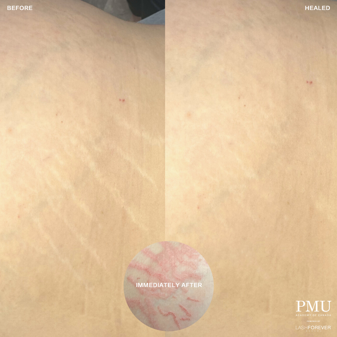 HDi Scar and Stretch Mark Camouflage – Vancouver - Lashforever Canada